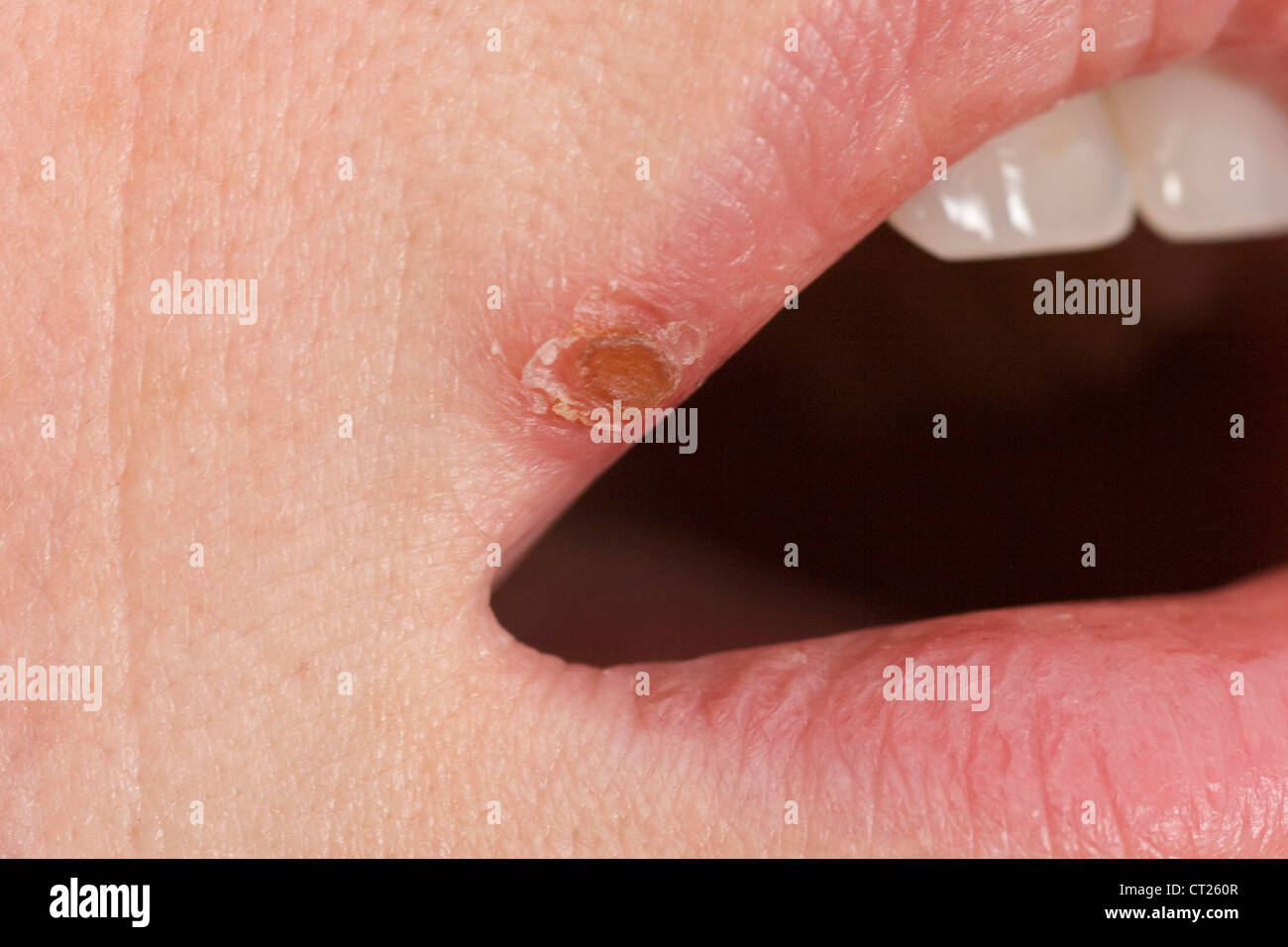 Herpes vesicle hi-res stock photography and images - Alamy