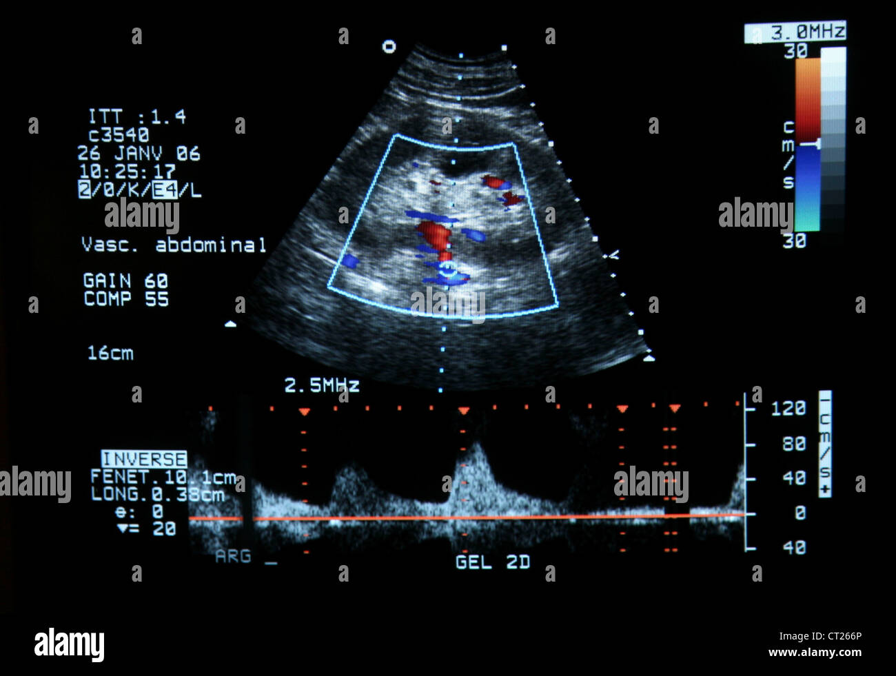 Kidney arteries scan hi-res stock photography and images - Alamy