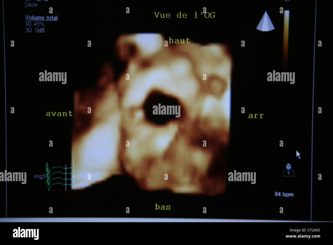 CONGENITAL HEART MALFORMATION Stock Photo - Alamy