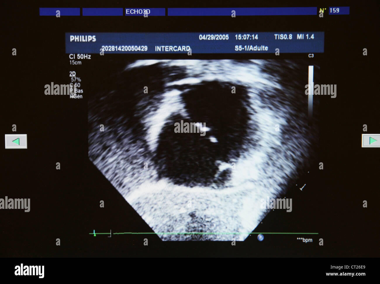 Cardiovascular malformation hi-res stock photography and images - Alamy