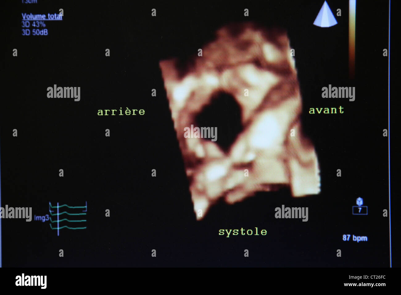 CONGENITAL HEART MALFORMATION Stock Photo - Alamy