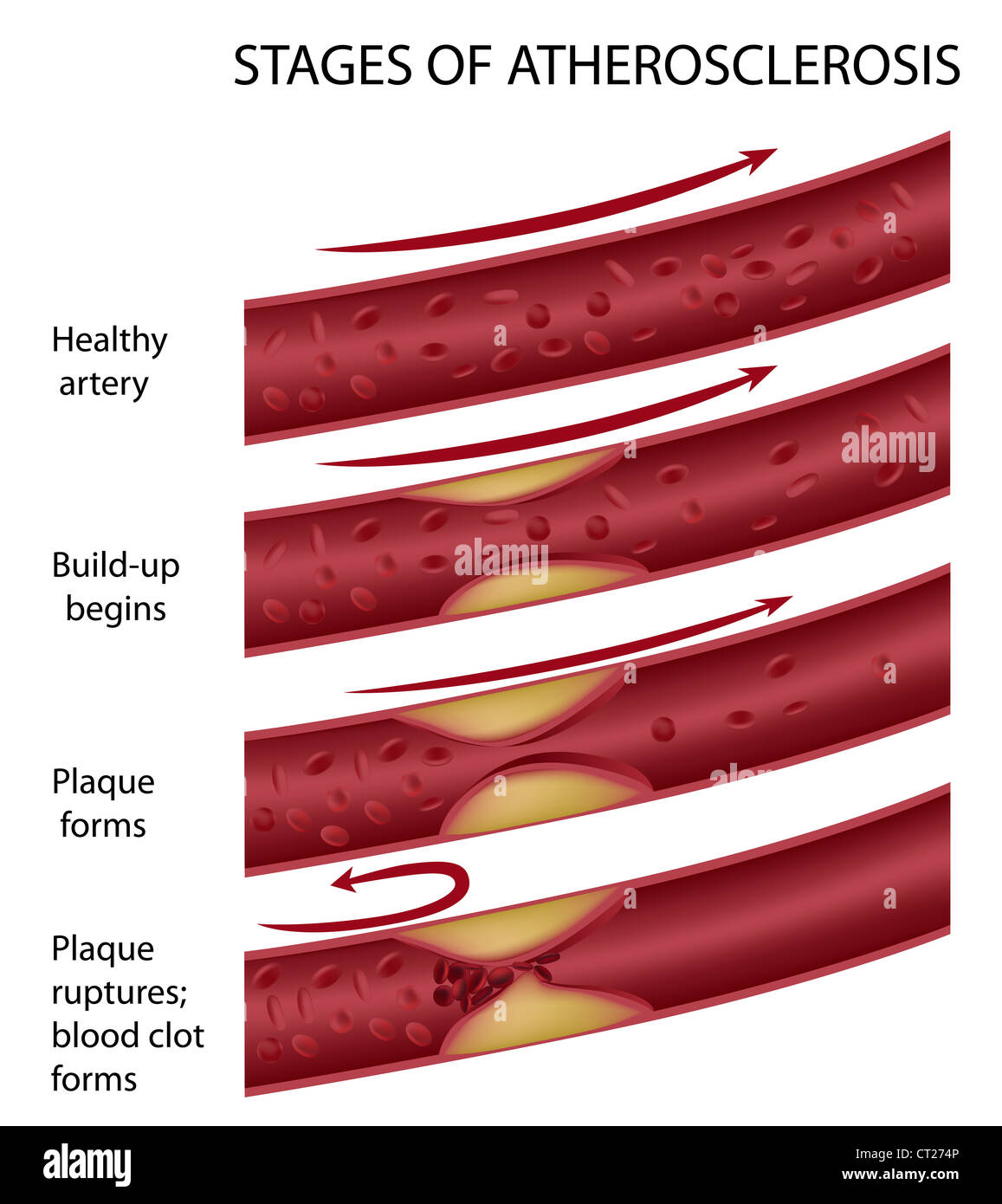 Stages of atherosclerosis Stock Photo - Alamy