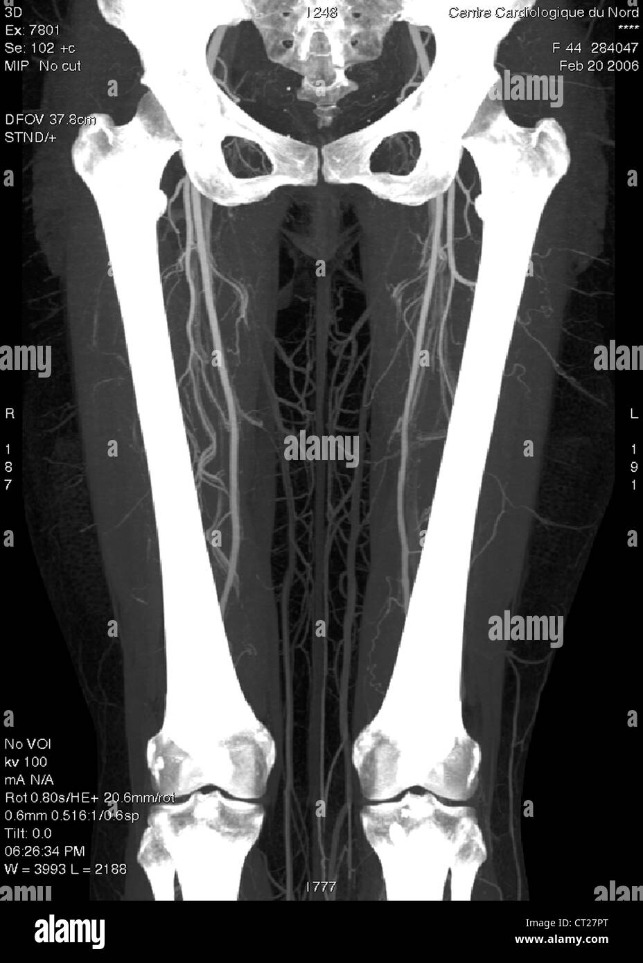 Deep femoral artery Black and White Stock Photos & Images - Alamy