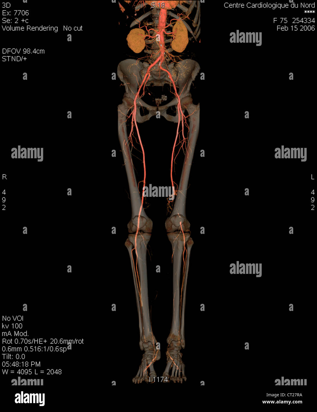 FEMORAL THROMBOSIS, 3D SCAN Stock Photo - Alamy
