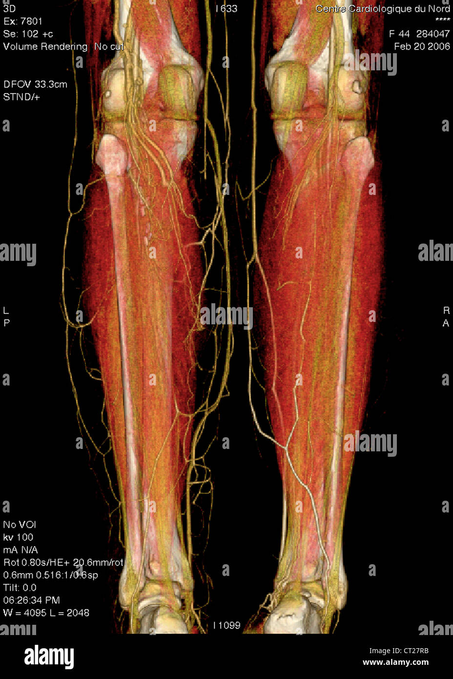 LOWER LIMB, 3D SCAN Stock Photo - Alamy