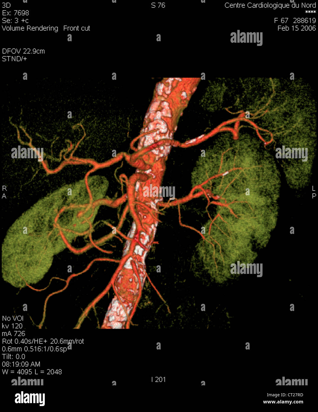 AORTA, 3D SCAN Stock Photo - Alamy