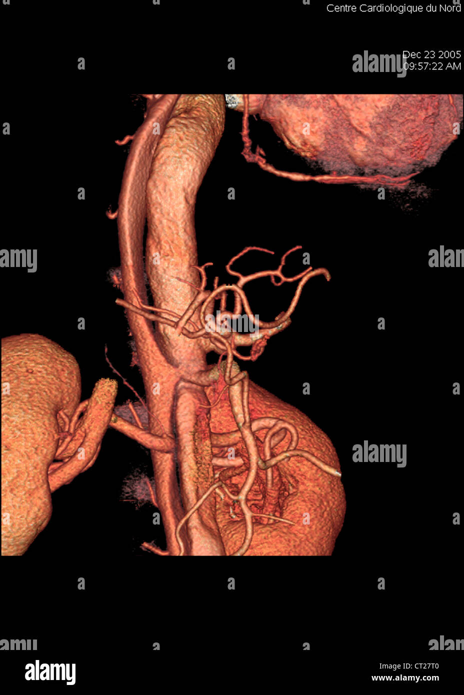 ANEURYSM OF THE AORTA, 3D SCAN Stock Photo - Alamy