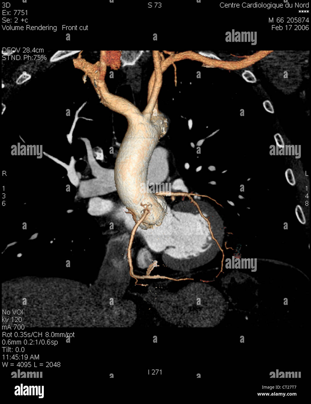 AORTA, 3D SCAN Stock Photo - Alamy