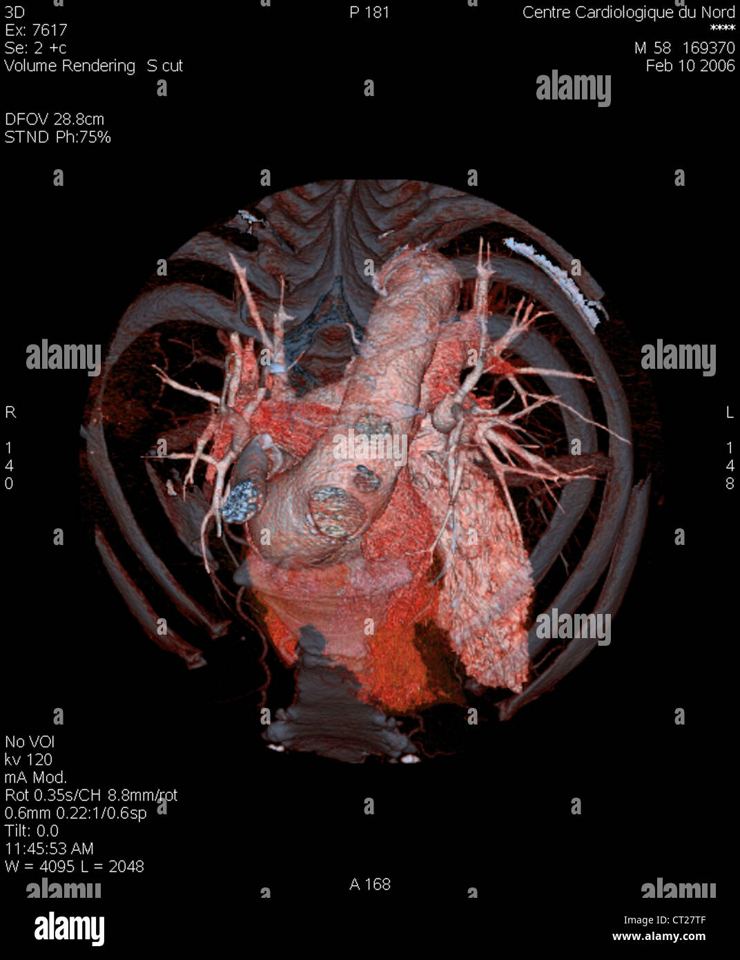 AORTA, 3D SCAN Stock Photo - Alamy