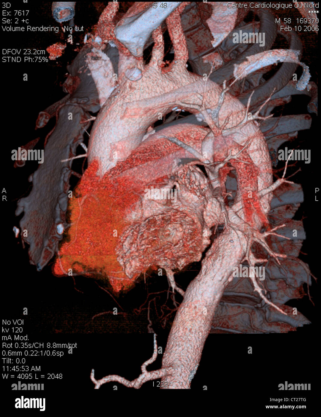 AORTA, 3D SCAN Stock Photo - Alamy