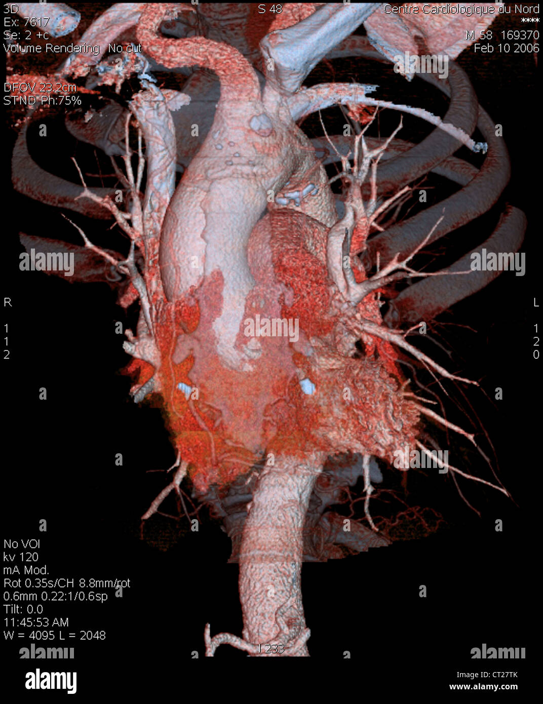AORTA, 3D SCAN Stock Photo - Alamy