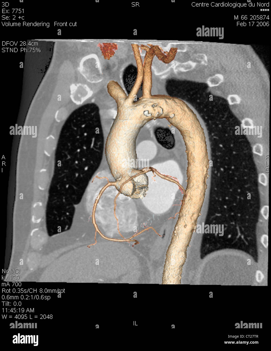 AORTA, 3D SCAN Stock Photo - Alamy