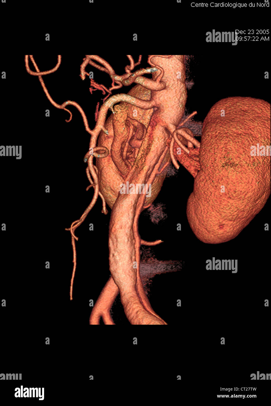 Abdominal aorta aneurysm scan hi-res stock photography and images - Alamy