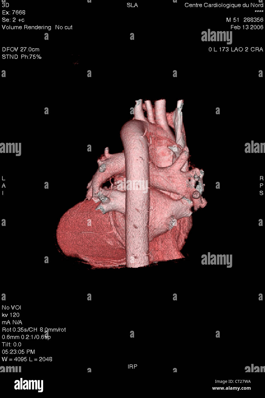 Heart blood vessels scan hi-res stock photography and images - Alamy
