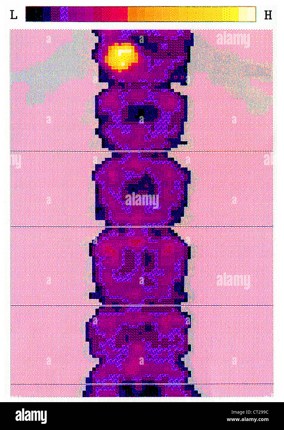 Normal bone density hi-res stock photography and images - Alamy