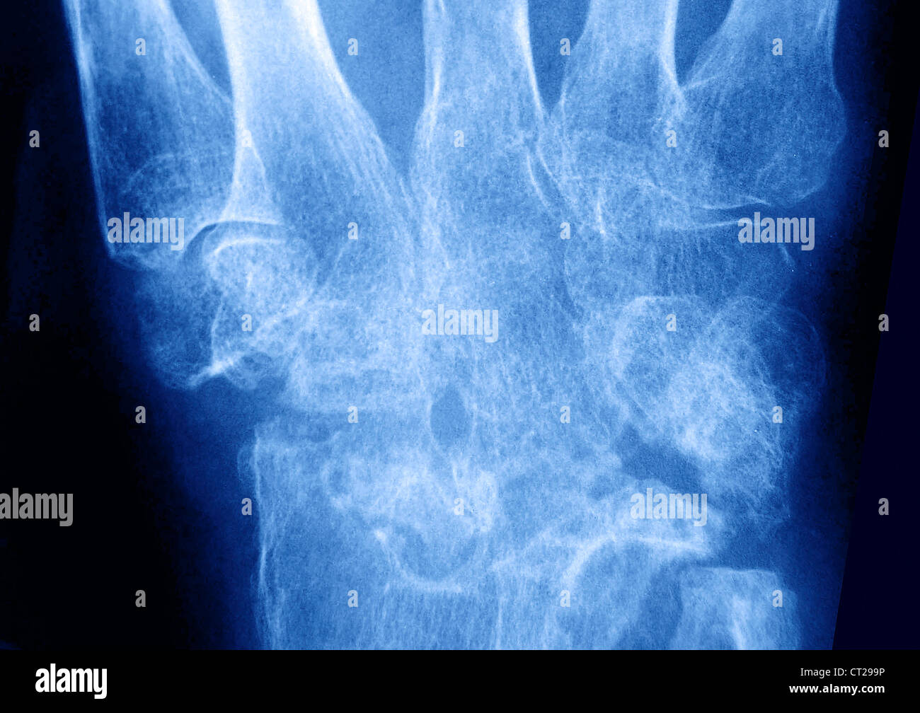 Rheumatoid arthritis hands x ray hi-res stock photography and images ...
