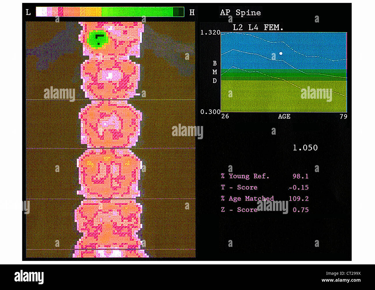 BONE DENSITOMETRY RESULT Stock Photo - Alamy