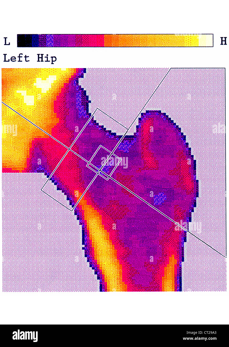 Osteopenia hi-res stock photography and images - Alamy