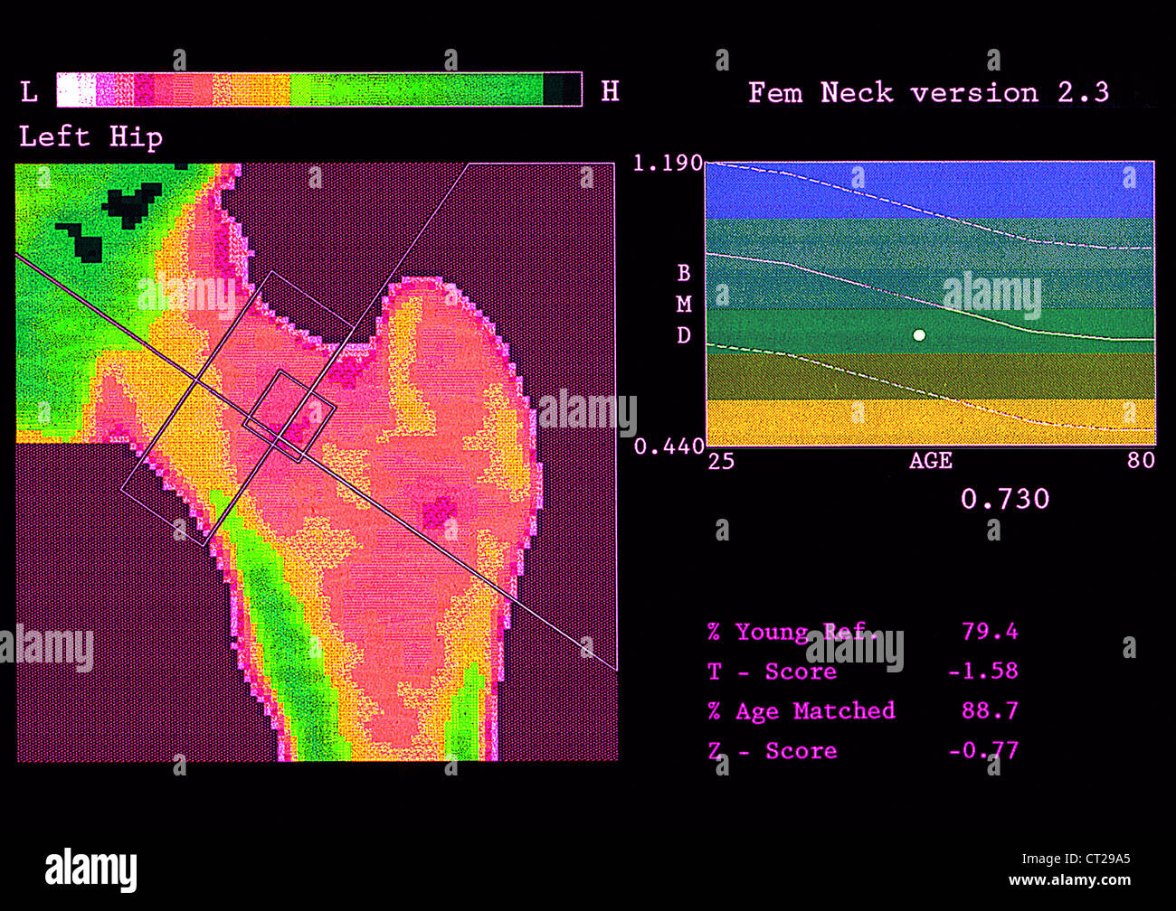 Osteopenia hi-res stock photography and images - Alamy