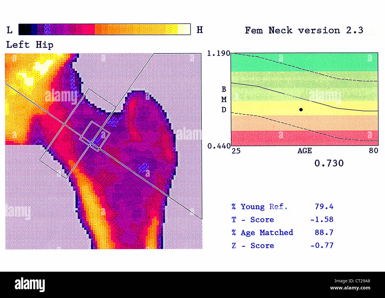Osteopenia hi-res stock photography and images - Alamy