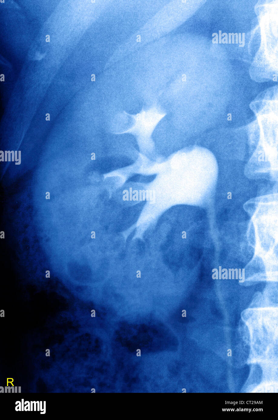 X ray urinary system normal hi-res stock photography and images - Alamy