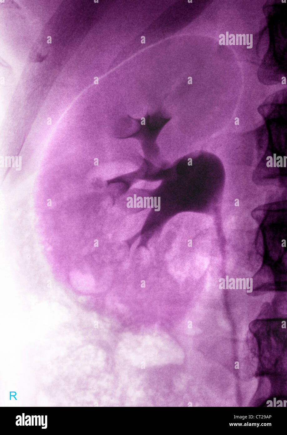 X ray urinary system normal hi-res stock photography and images - Alamy