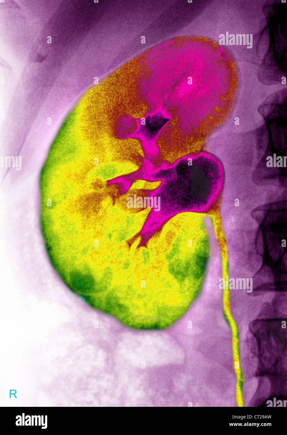 Pyelon hi-res stock photography and images - Alamy