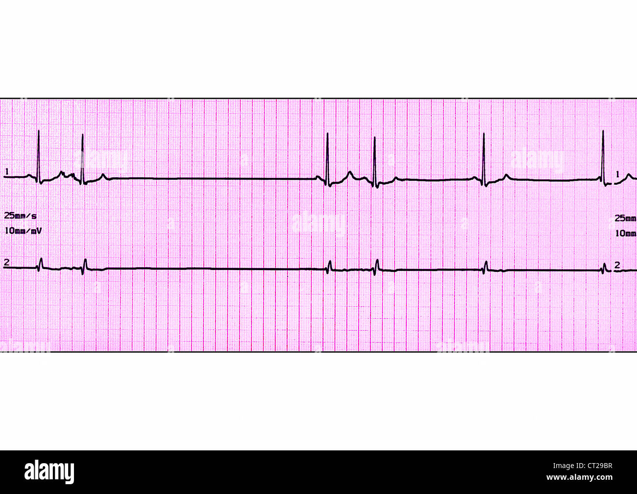 EXTRASYSTOLE ECG Stock Photo Alamy EXTRASYSTOLE ECG Stock Photo Alamy