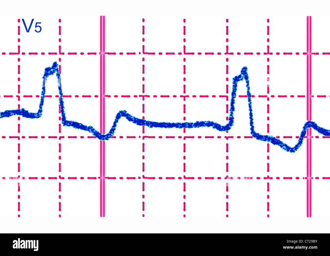 BUNDLE BRANCH BLOCK, ECG Stock Photo - Alamy