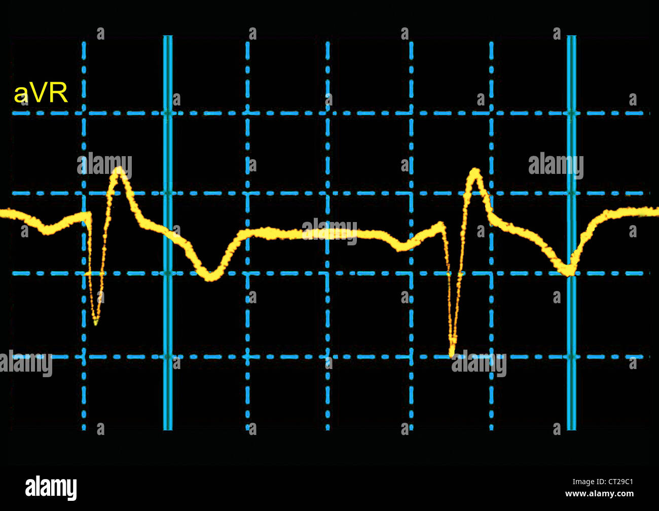 RIGHT BUNDLE-BRANCH BLOCK, ECG Stock Photo - Alamy