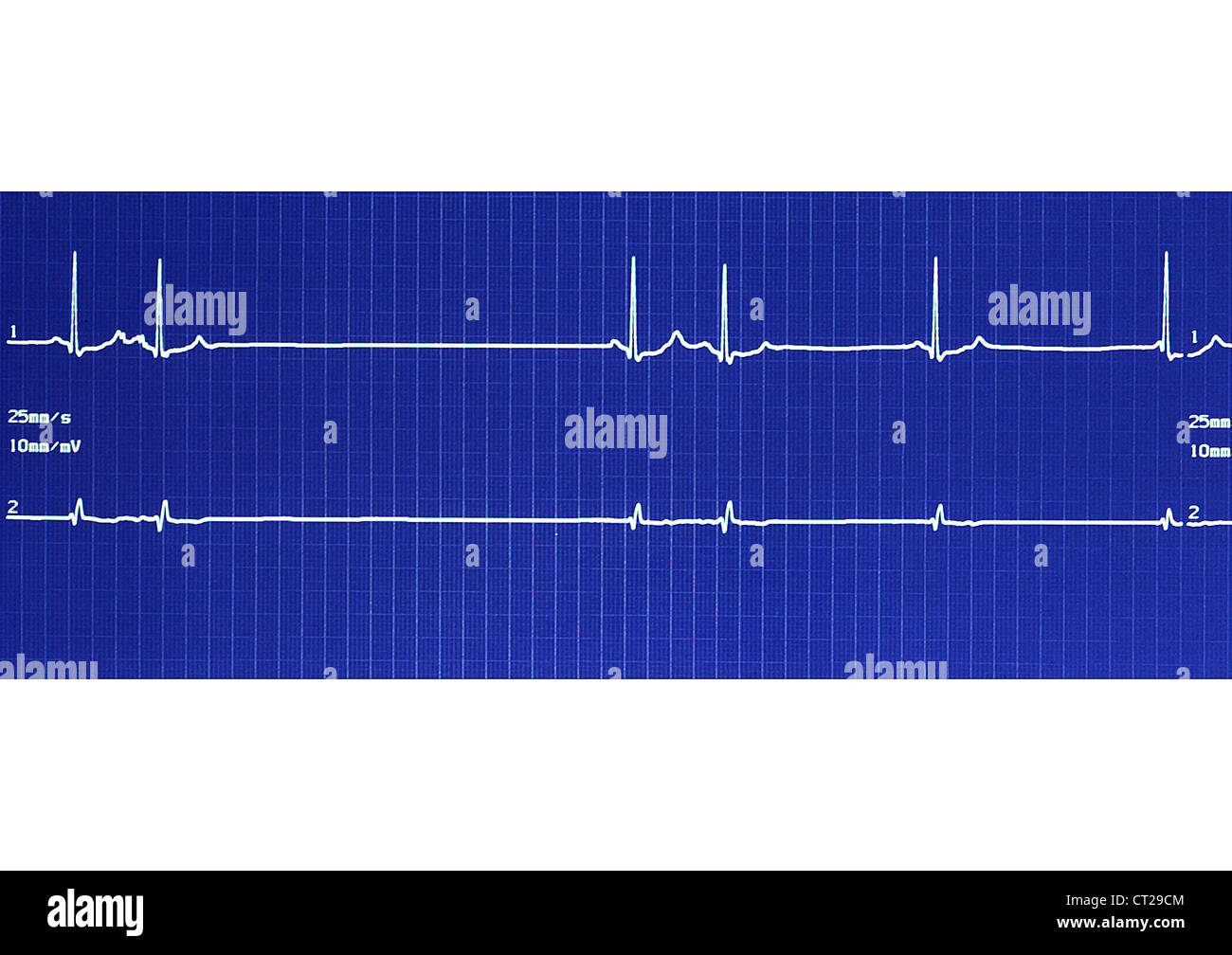 Extrasystole hi-res stock photography and images - Alamy