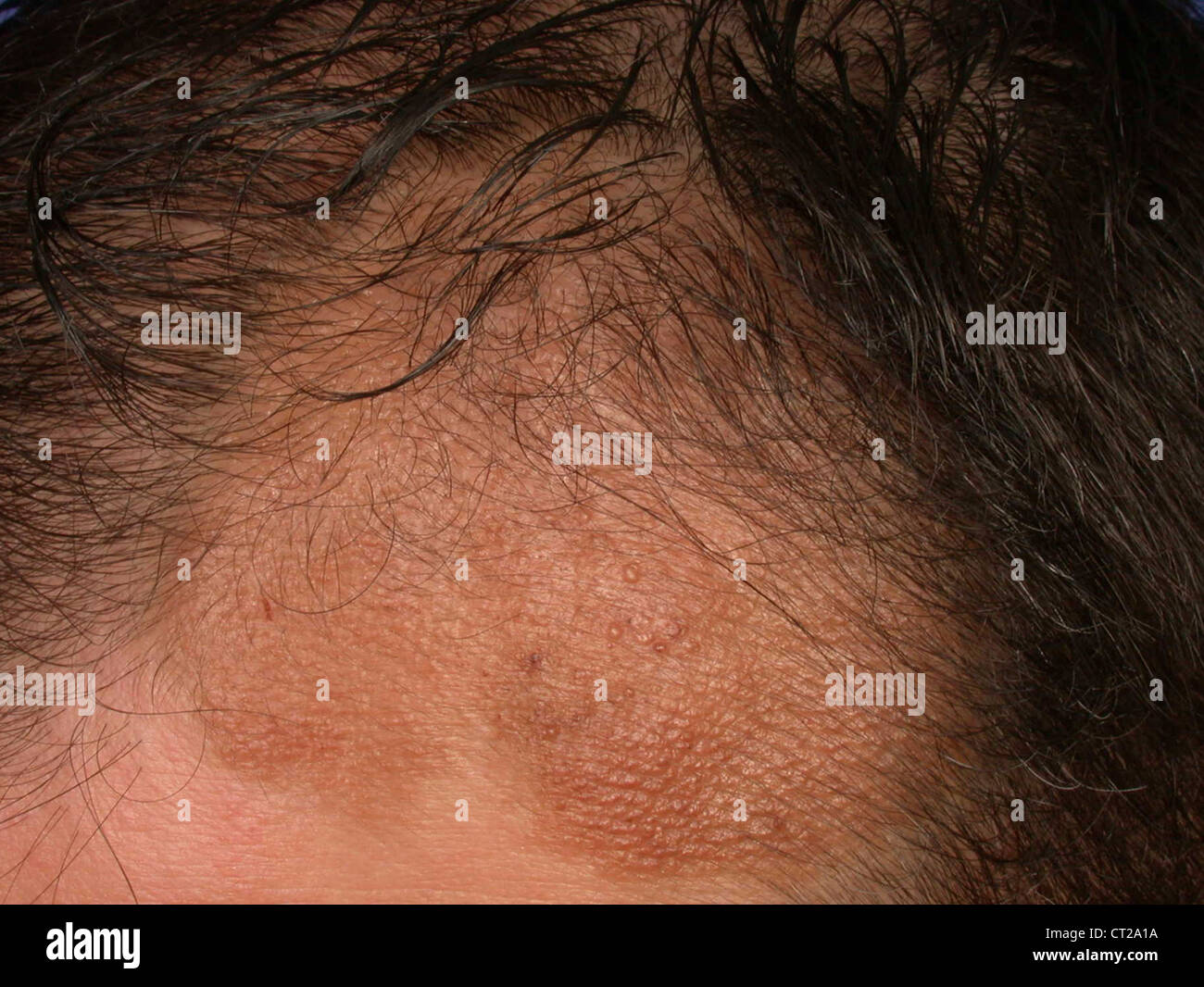Giant hairy nevus hi-res stock photography and images - Alamy