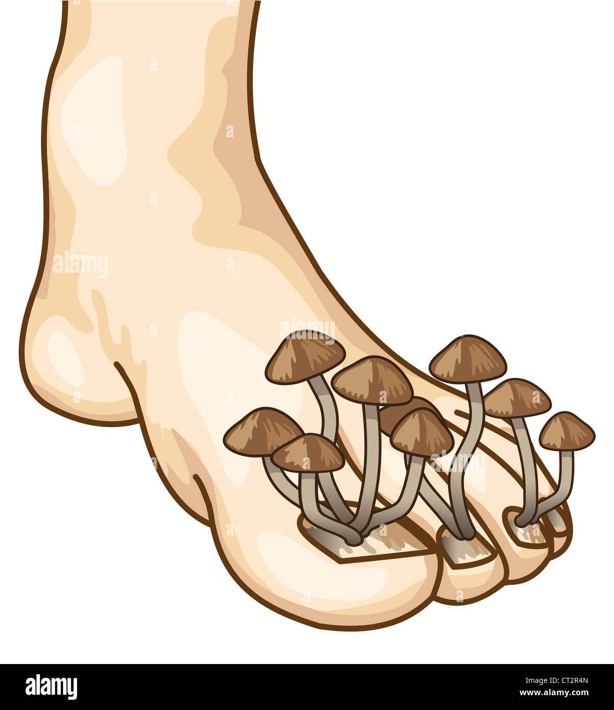 Onychomycosis. Vector illustraion Stock Photo - Alamy