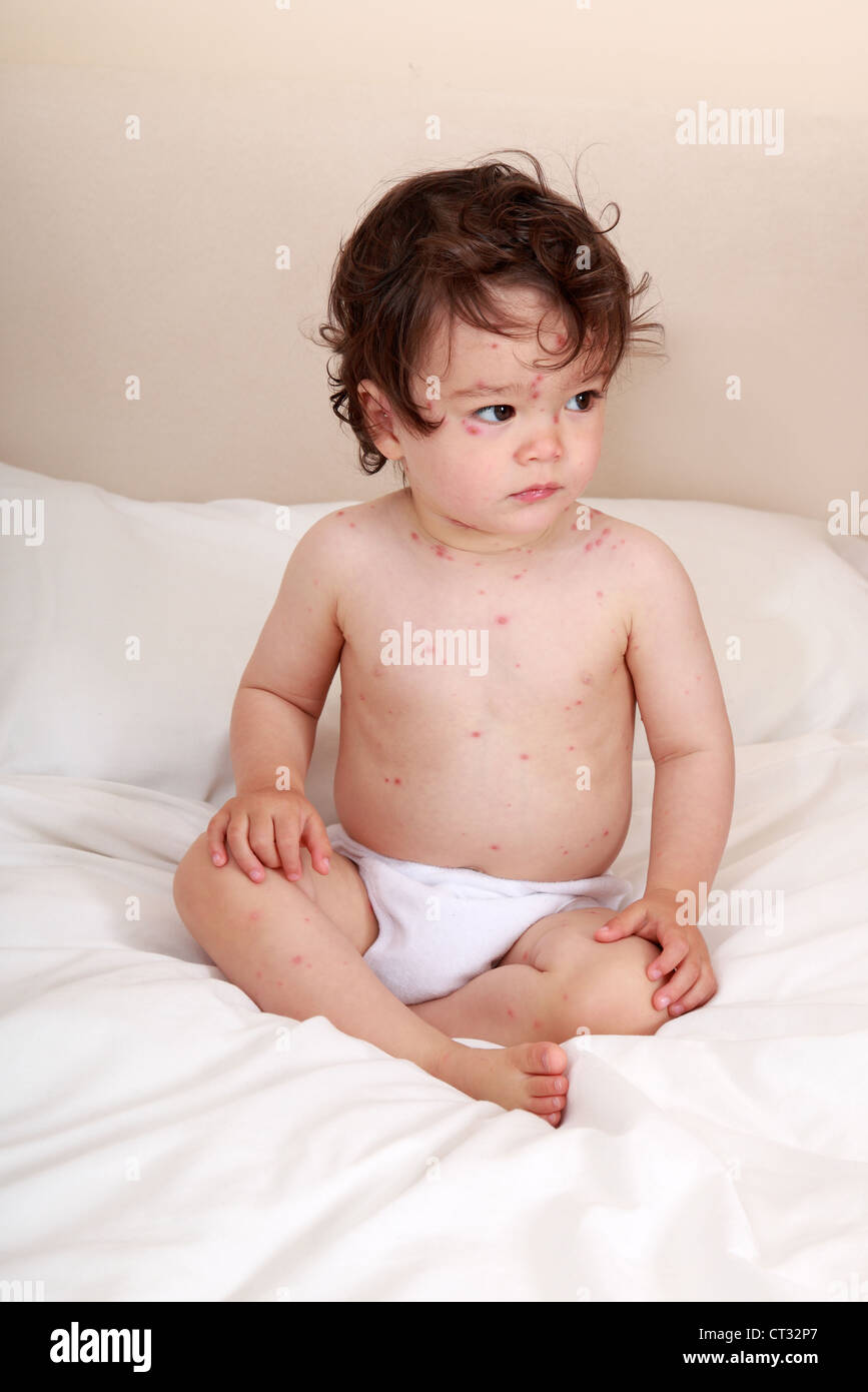 Chickenpox rash hi-res stock photography and images - Alamy