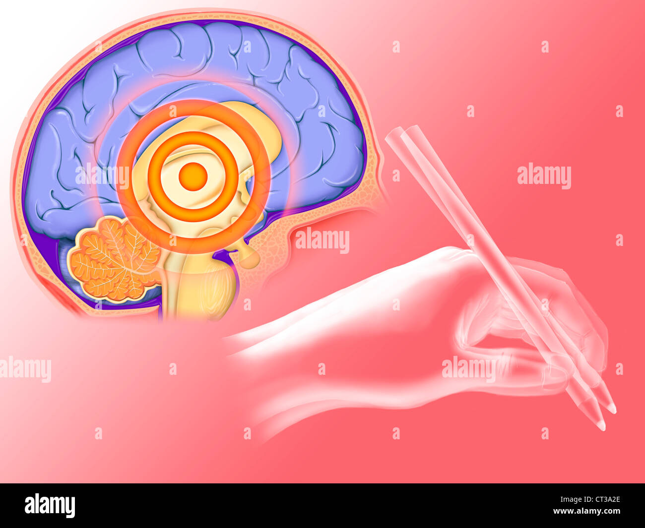 PARKINSON'S DISEASE, DRAWING Stock Photo - Alamy