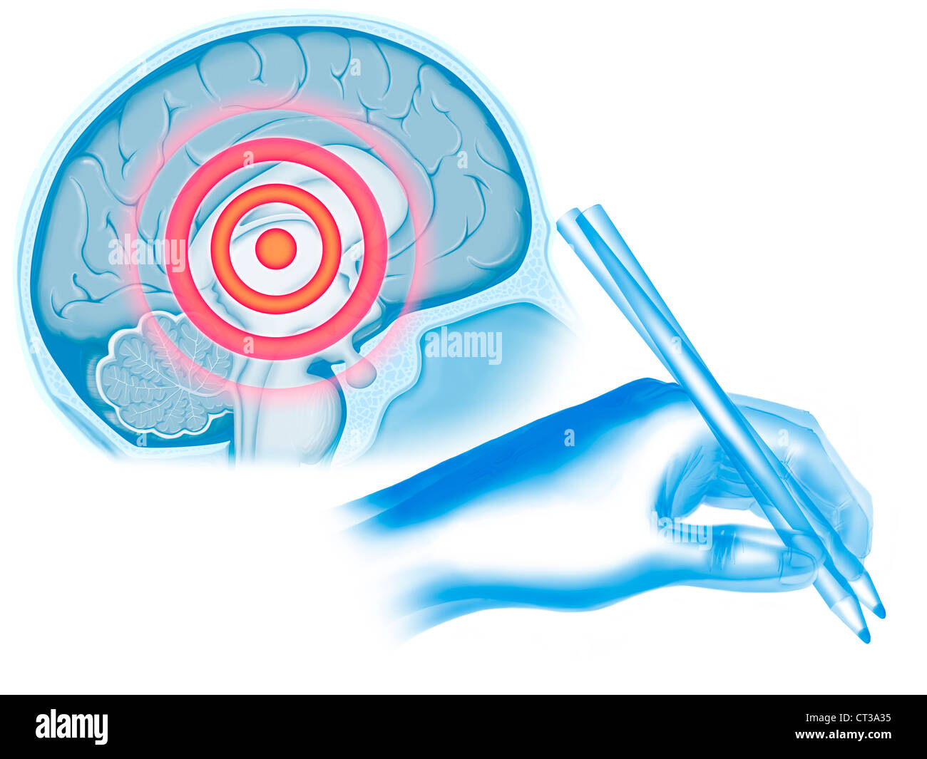 PARKINSON'S DISEASE, DRAWING Stock Photo - Alamy