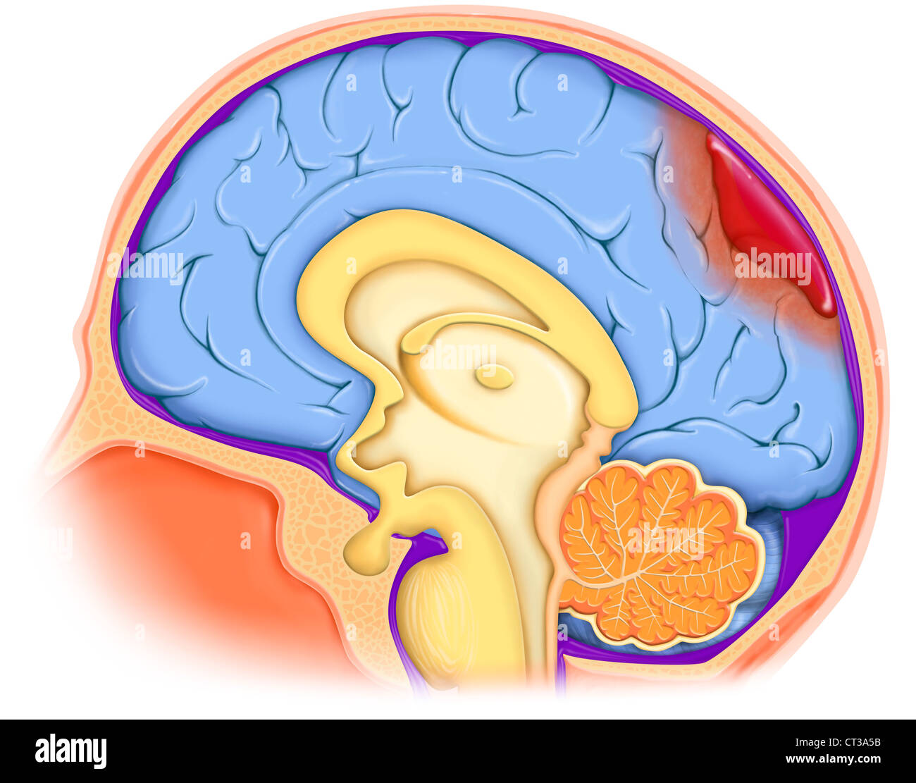 Brain Hemorrhage Illustration Stock Photos & Brain Hemorrhage ...