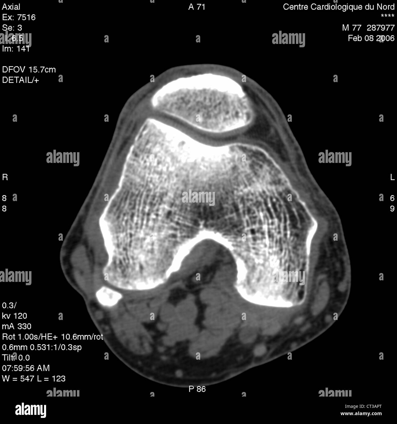 Scan of human knees bones and joints hi-res stock photography and ...