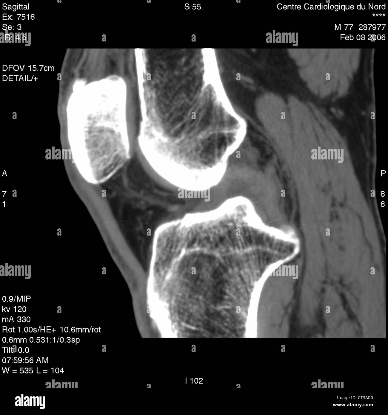 Bone Scan Knees High Resolution Stock Photography and Images - Alamy
