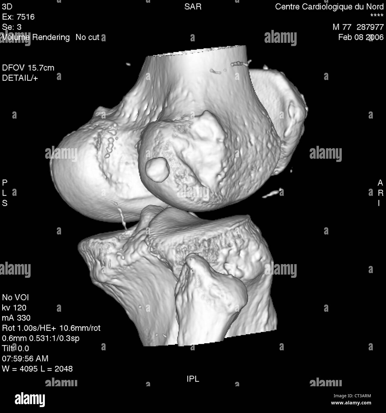 Scan of human knees bones and joints hi-res stock photography and ...