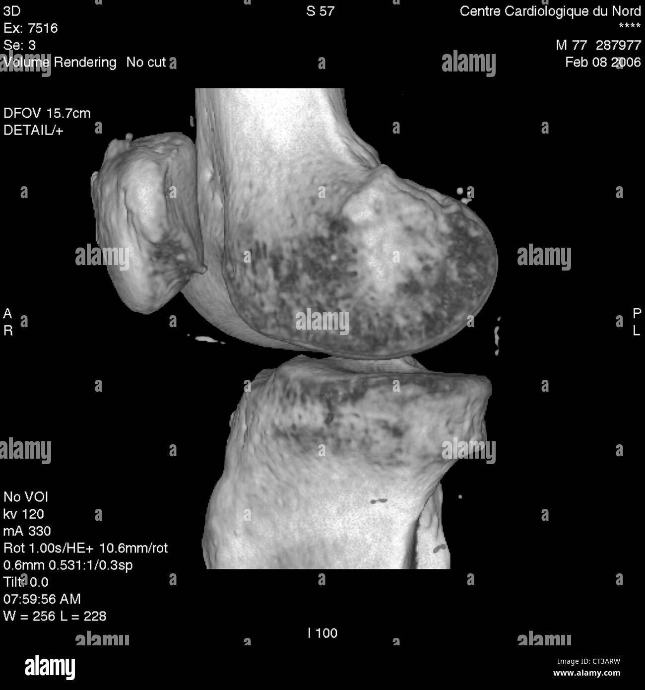 Lower limb 3d scan hi-res stock photography and images - Alamy