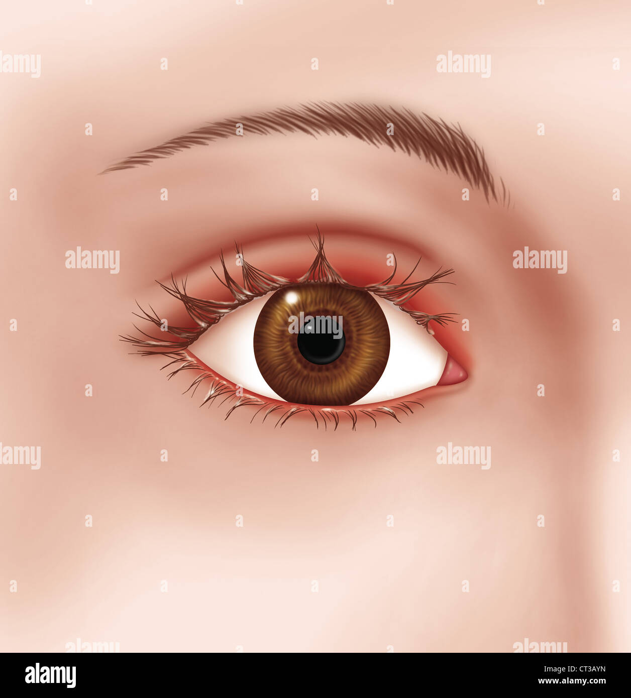 Blepharitis eyelid inflammation hi-res stock photography and images - Alamy