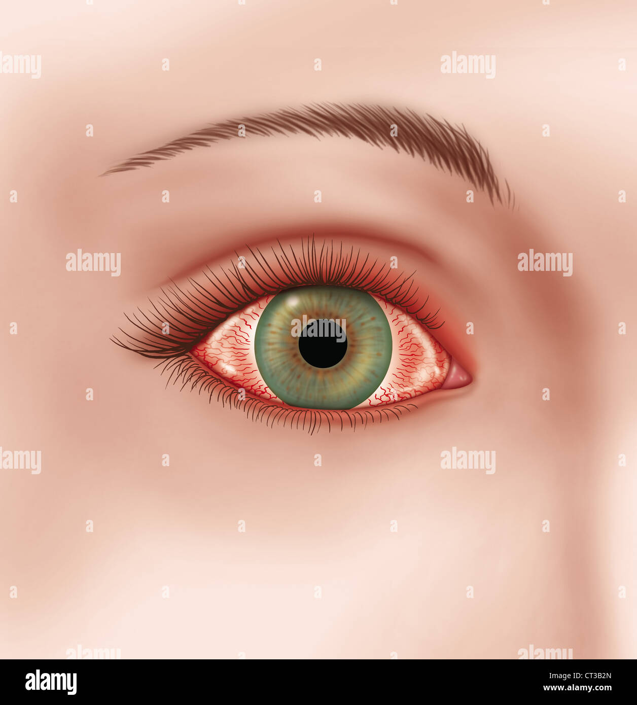 ALLERGIC CONJUNCTIVITIS, DRAWING Stock Photo - Alamy