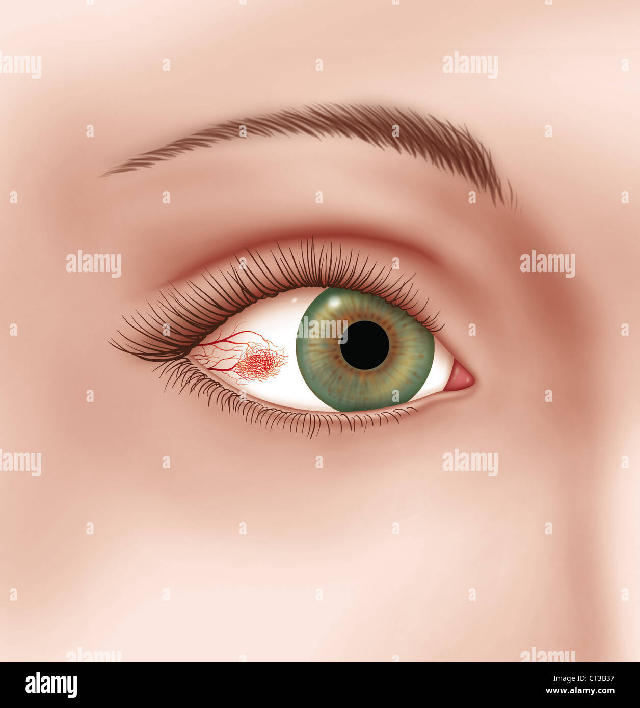 EPISCLERITIS, ILLUSTRATION Stock Photo - Alamy