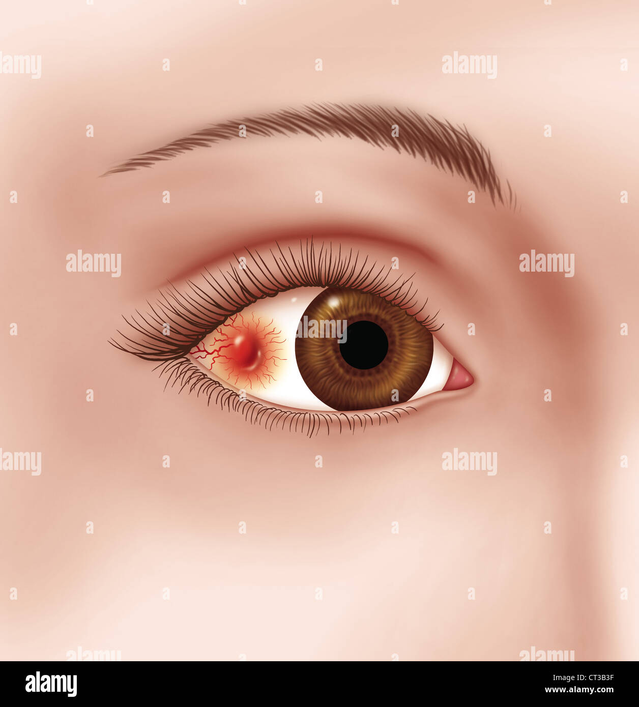 NODULAR SCLERITIS, DRAWING Stock Photo, Royalty Free Image: 49247059 ...