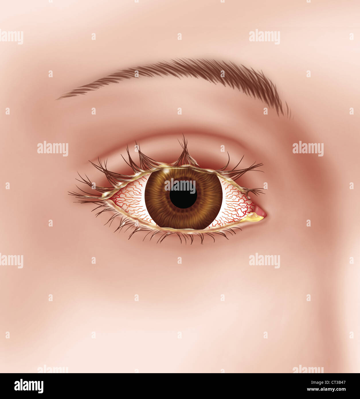 INFECTIOUS CONJUNCTIVITIS, DRAW Stock Photo - Alamy