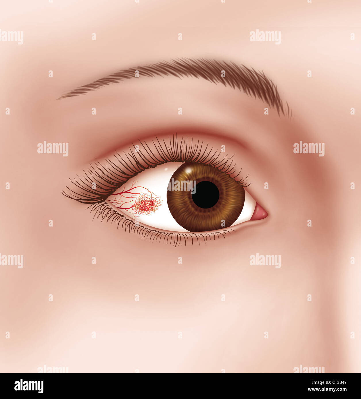 Episcleritis hi-res stock photography and images - Alamy