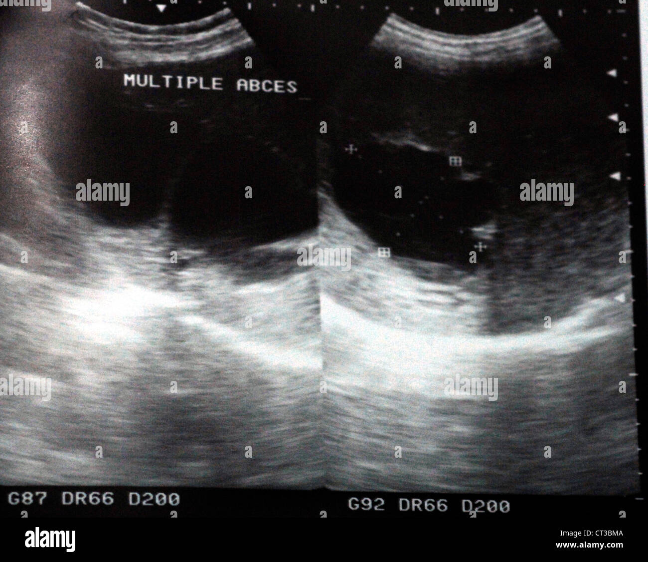 Abscess hi-res stock photography and images - Alamy