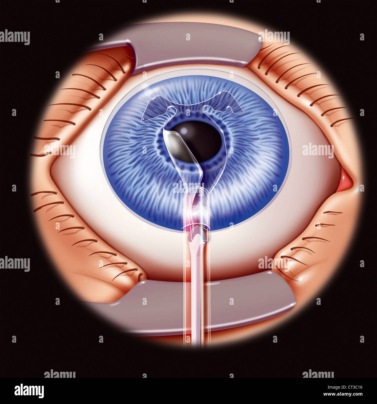 Prosthetic intra ocular lens implants hi-res stock photography and ...