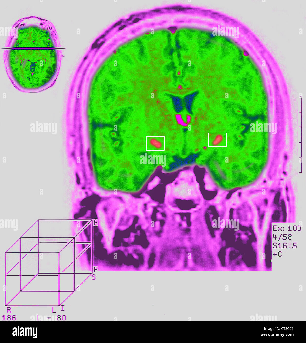 PARKINSON'S DISEASE, MRI Stock Photo - Alamy